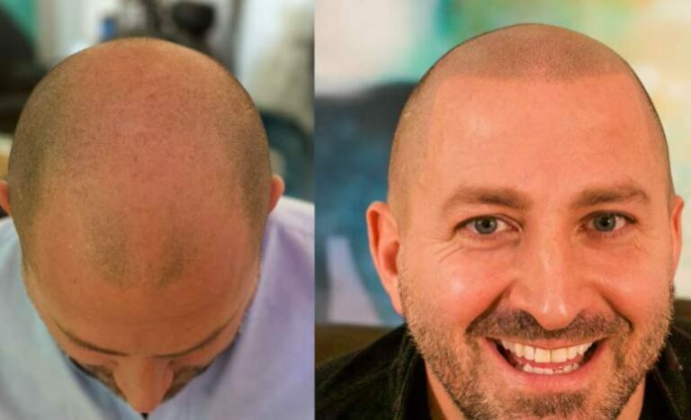 SMP Hairline Procedure To Thicken Hairlines